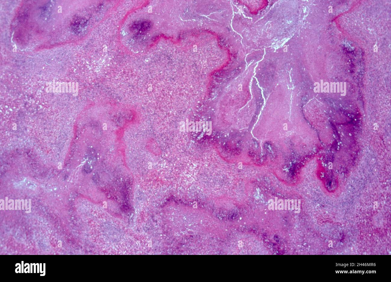 Amoebiasis: amoebic abscess of liver Stock Photo - Alamy