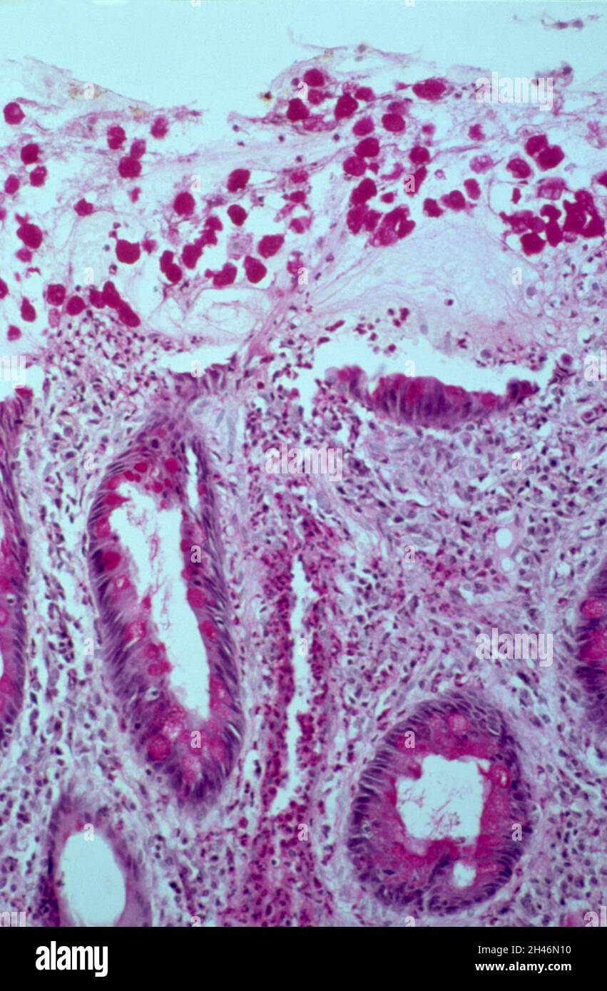 Colonoscopy illustrations hi-res stock photography and images - Alamy