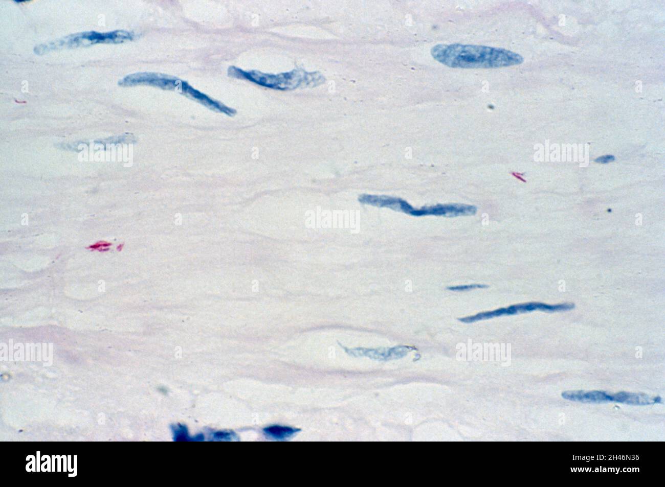 Leprosy: skin biopsy Stock Photo - Alamy