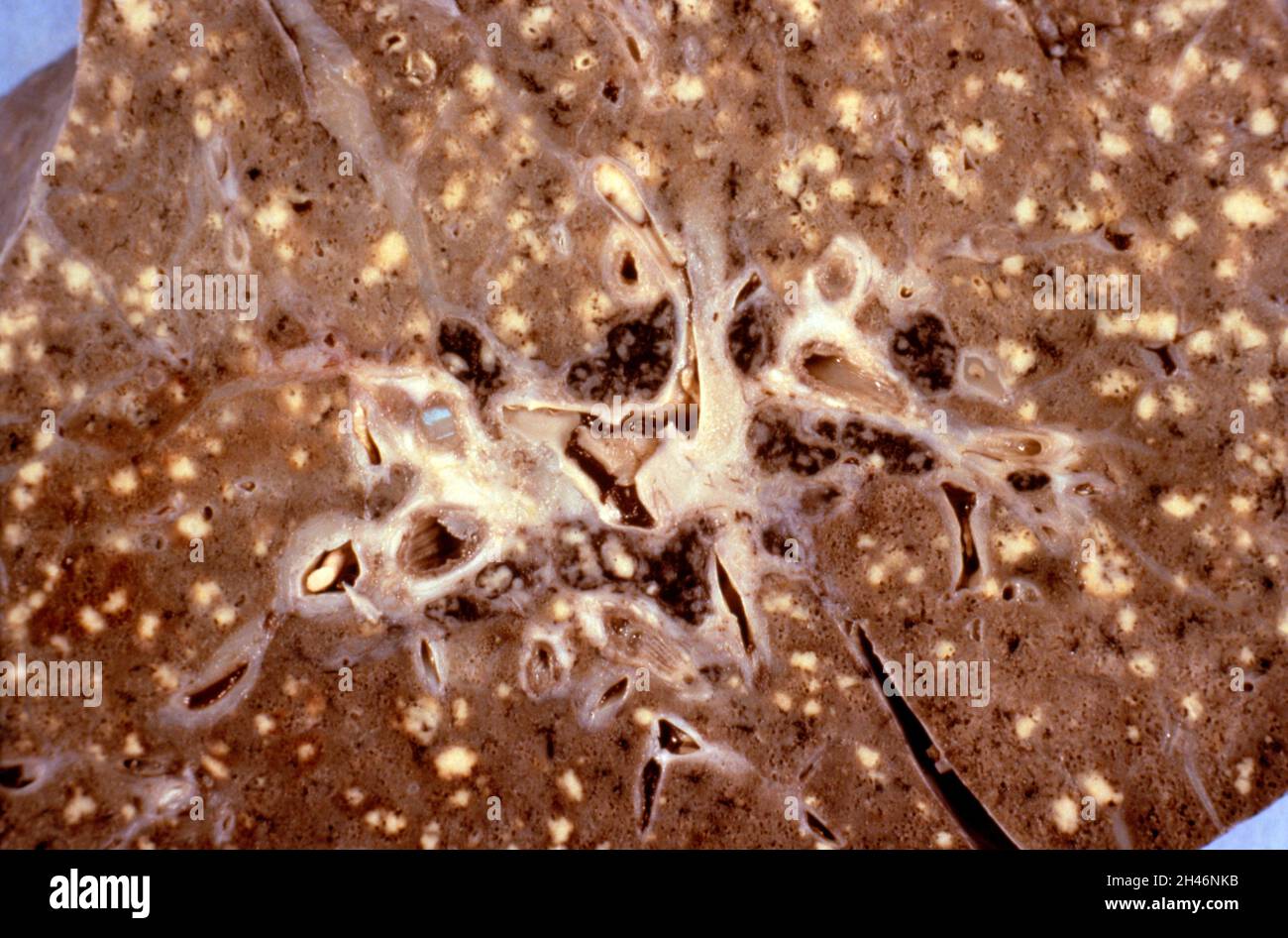 Lung: miliary tuberculosis Stock Photo - Alamy