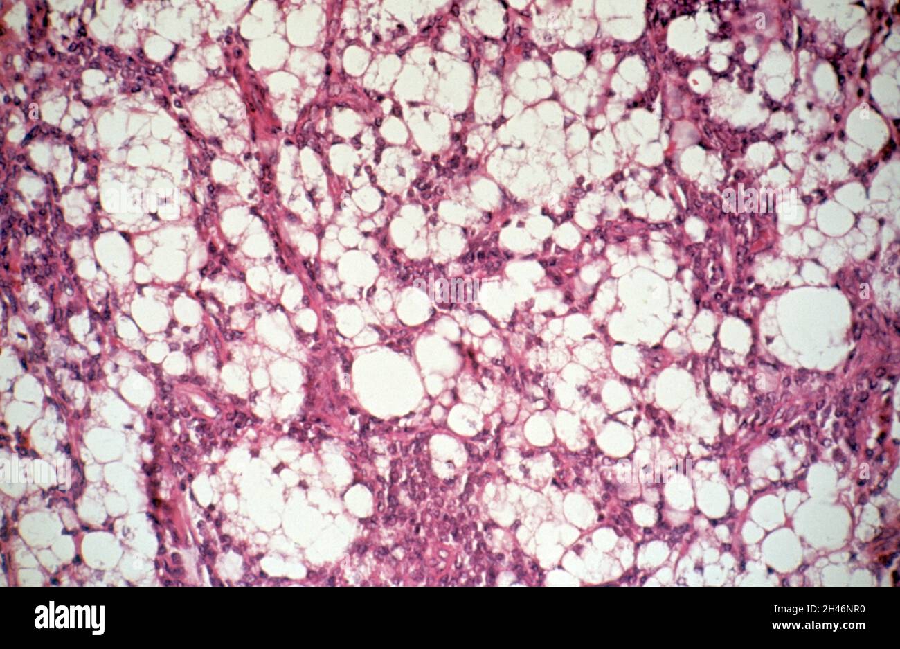 Lepromatous leprosy: lymph node Stock Photo - Alamy