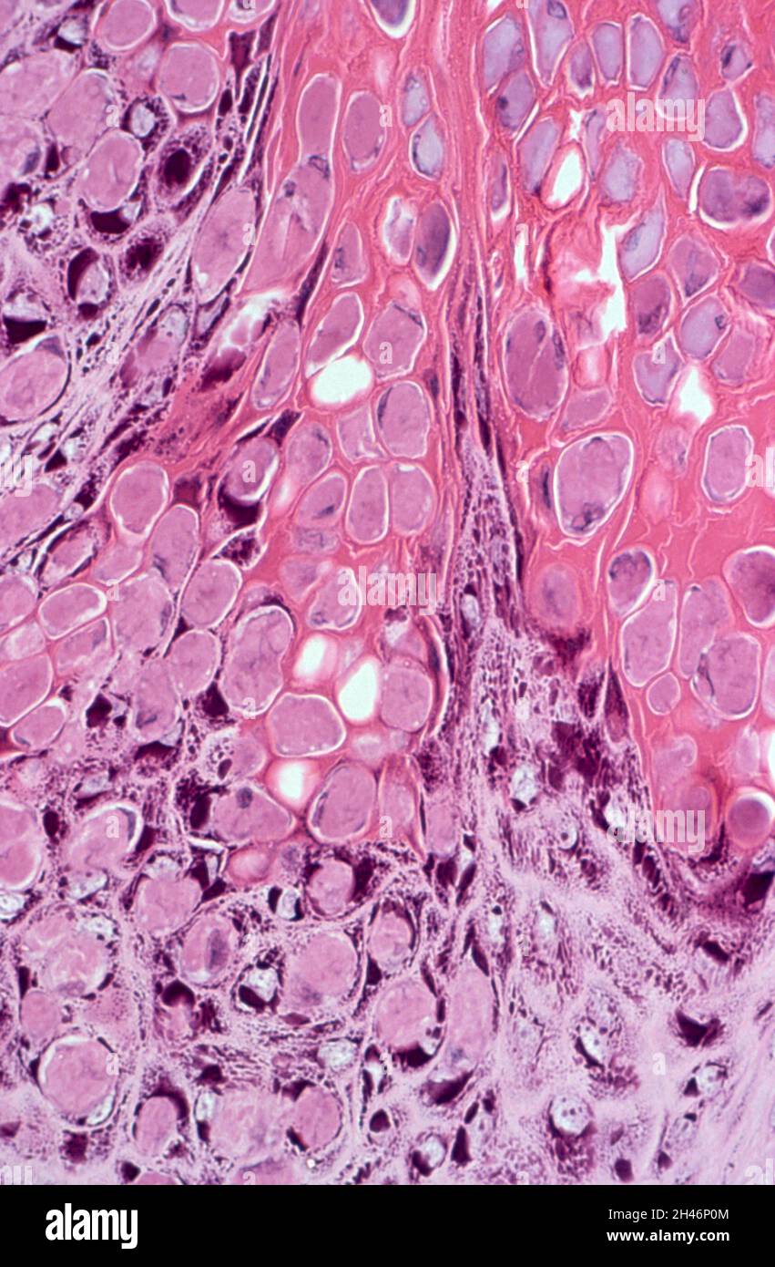 Contagiosum hi-res stock photography and images - Alamy