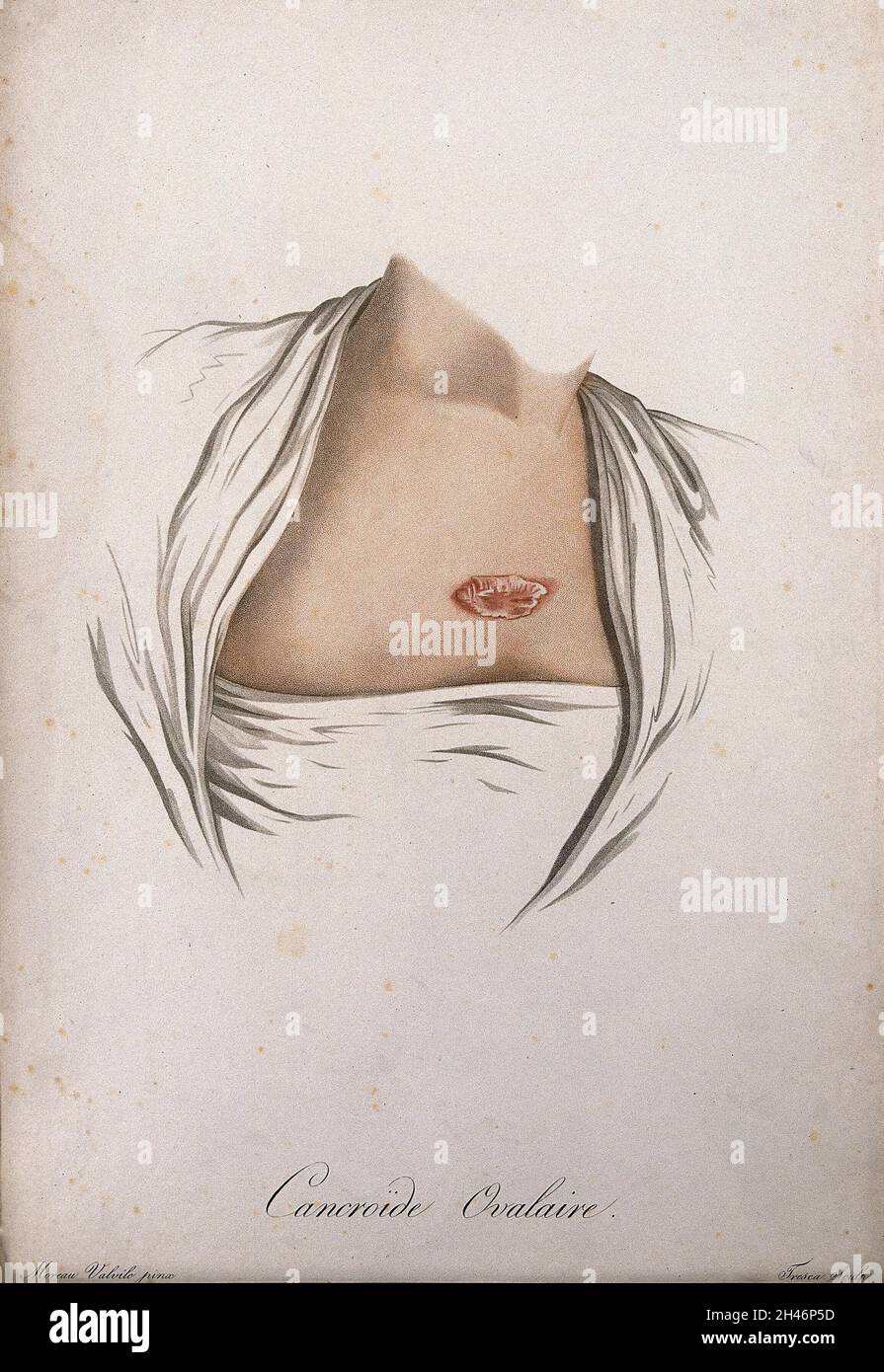 A chest with an area of skin disease. Coloured stipple engraving by S ...