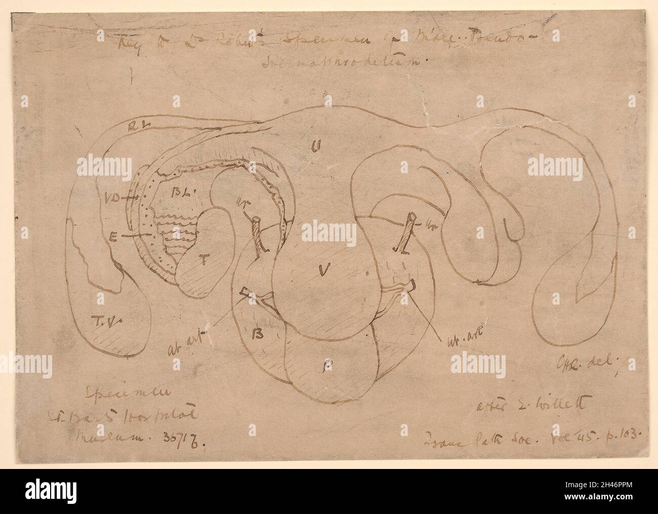 Diagram of the pelvic organs of a man who suffered from hermaphroditism ...
