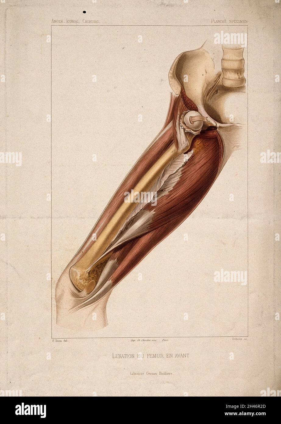 A dislocated femur bone: dissection of the thigh, showing the bone and ...