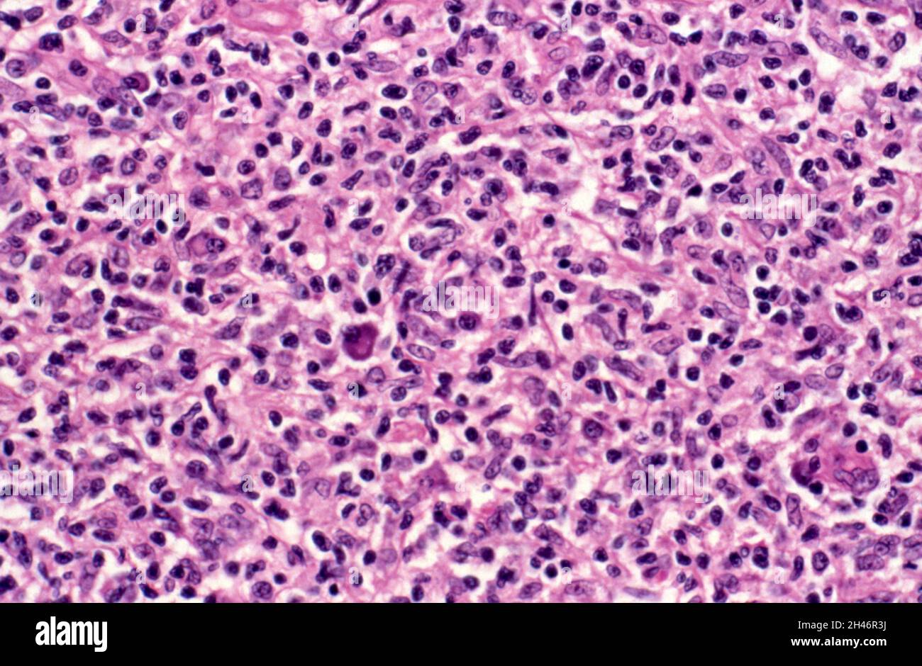 Post kala azar dermal leishmaniasis: skin lesion Stock Photo - Alamy