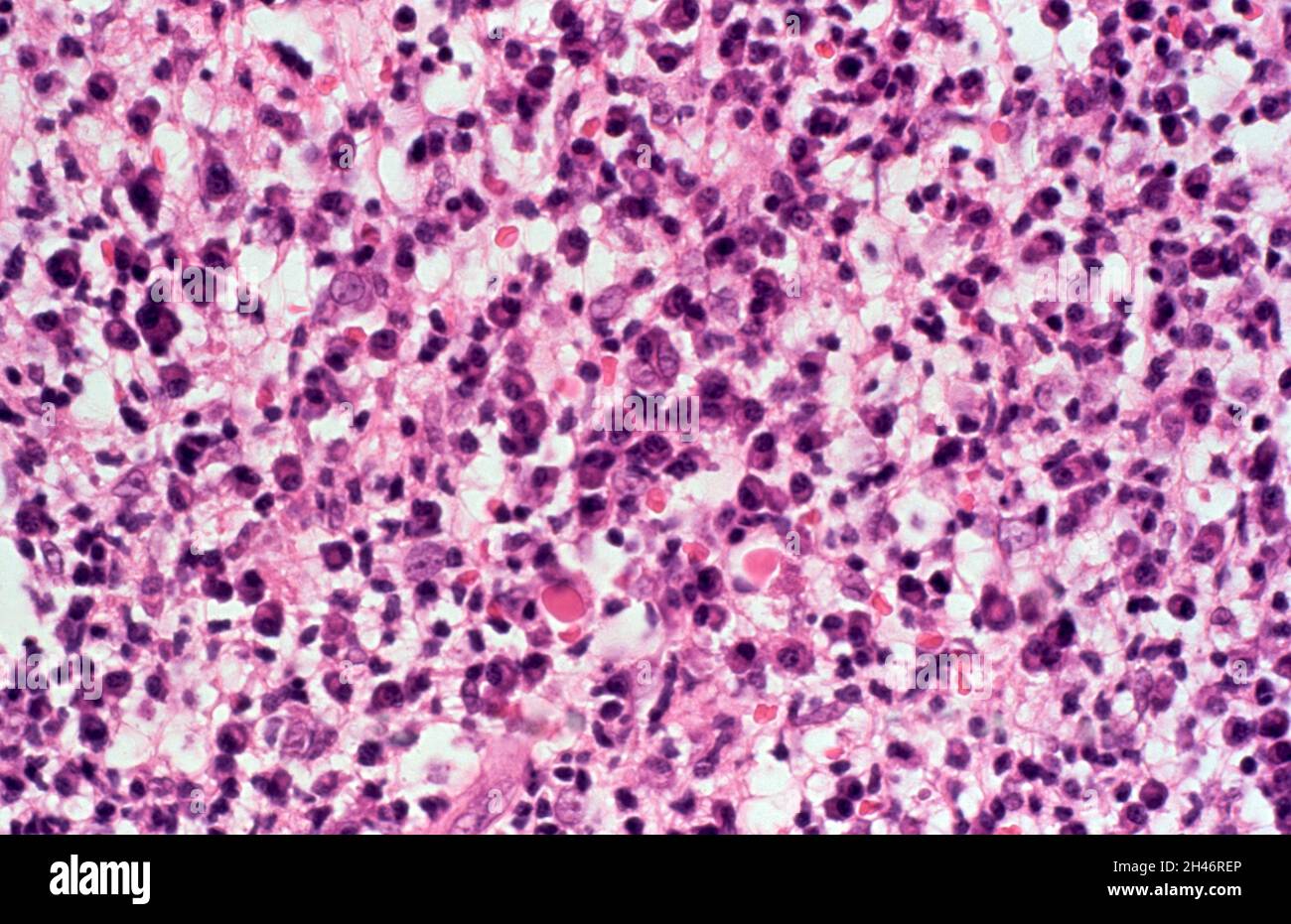 Cutaneous leishmaniasis: skin lesion Stock Photo - Alamy