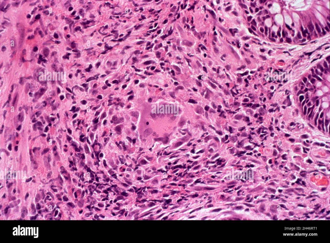 Schistosomiasis: histopathology of the large intestine Stock Photo - Alamy