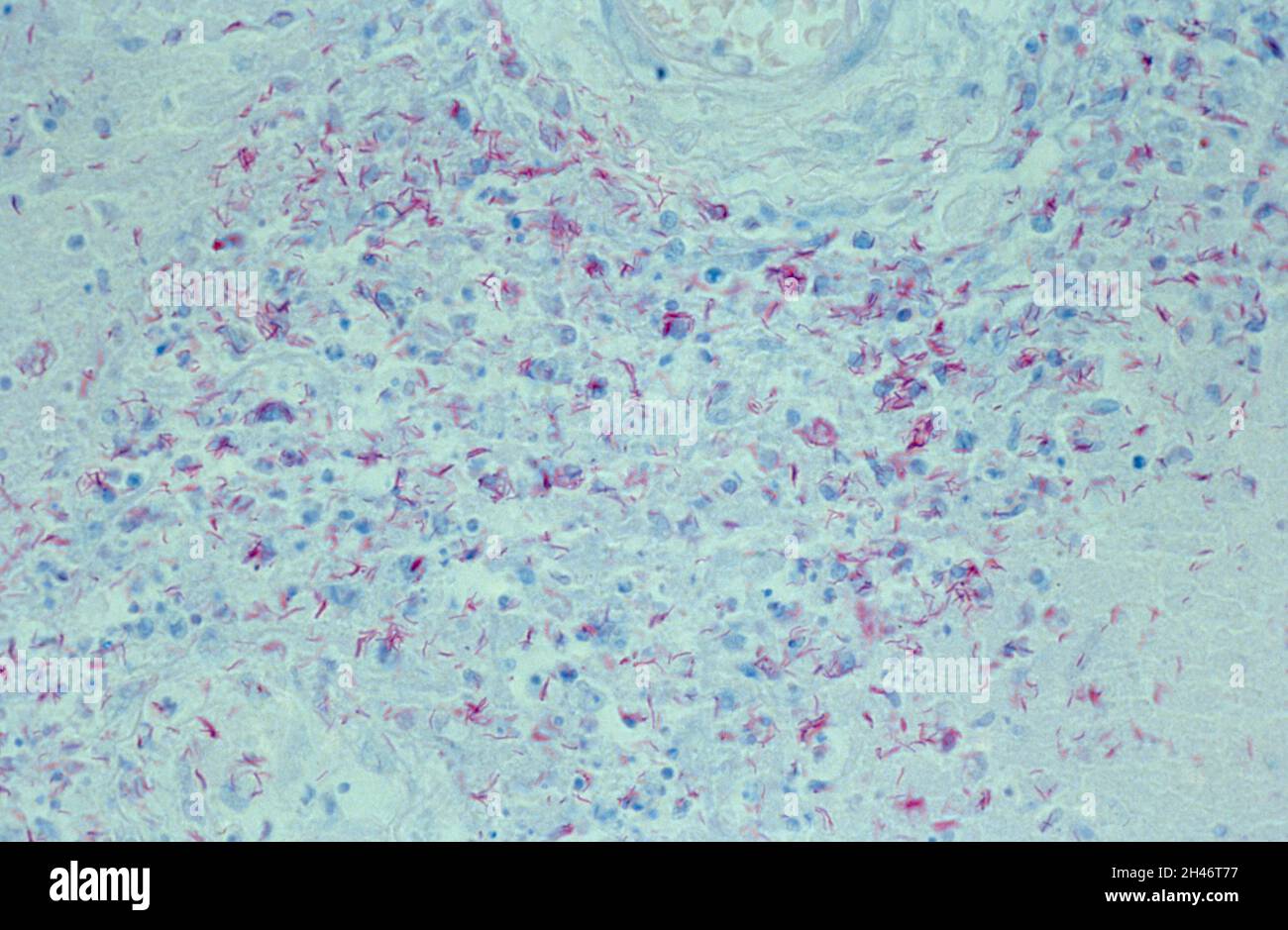 Tuberculous meningitis hi-res stock photography and images - Alamy