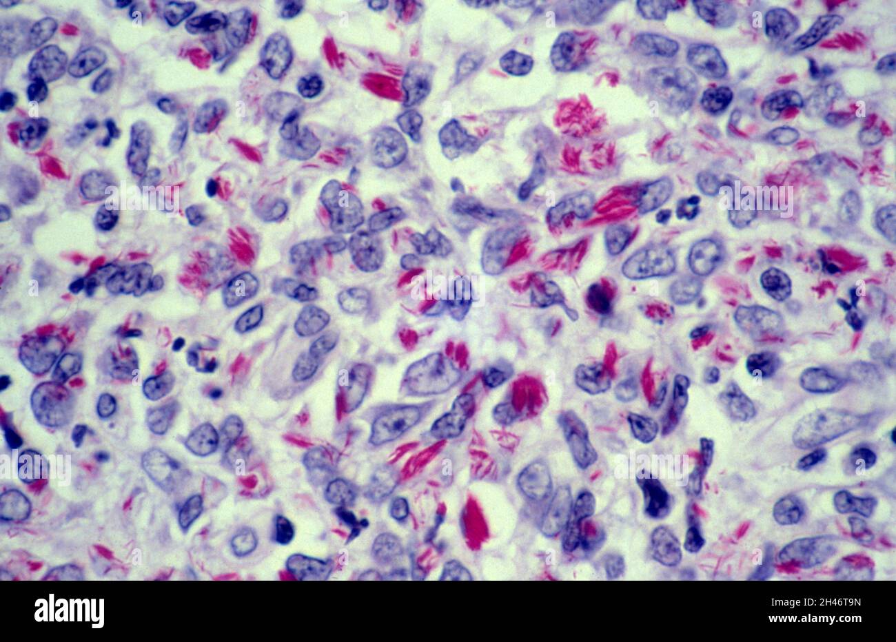 Lepromatous leprosy: histoid leprosy Stock Photo - Alamy