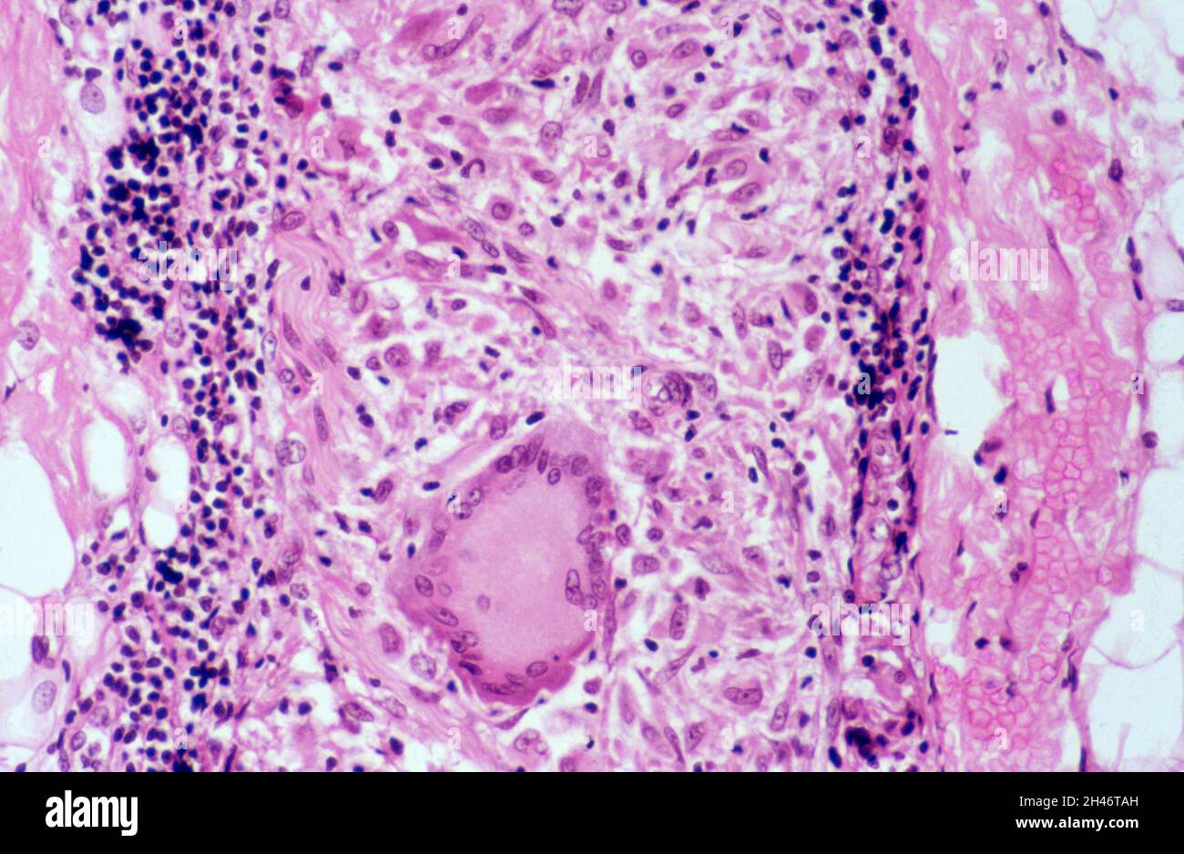 Leprosy: skin section Stock Photo - Alamy