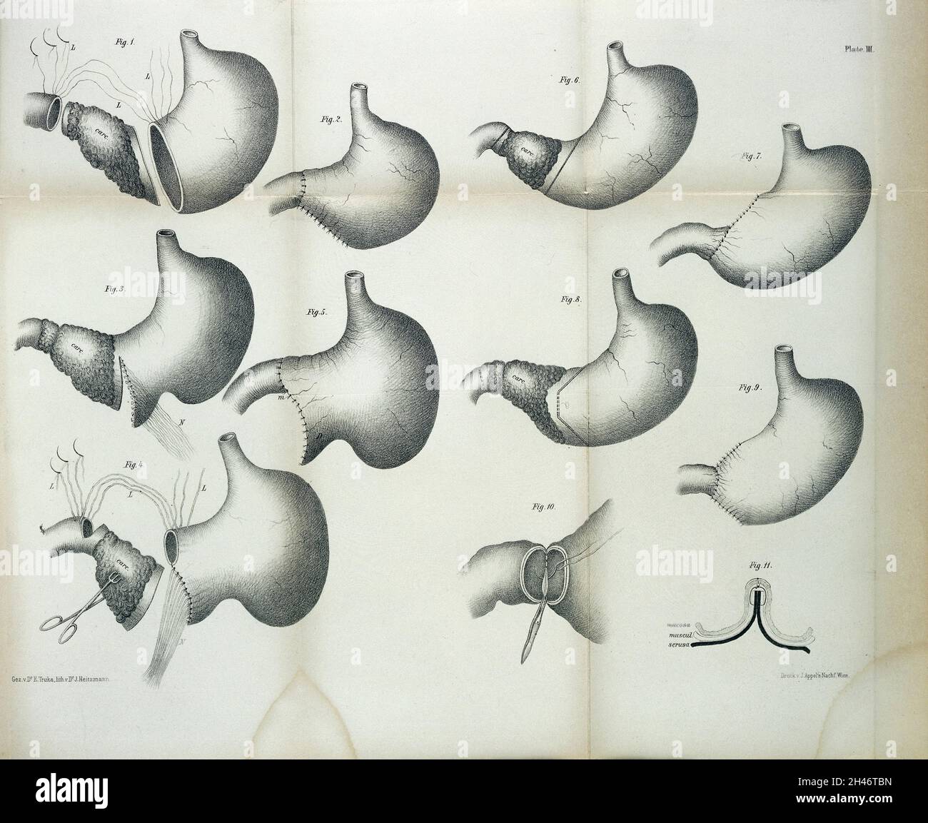 Successive phases of resection of stomach Stock Photo - Alamy