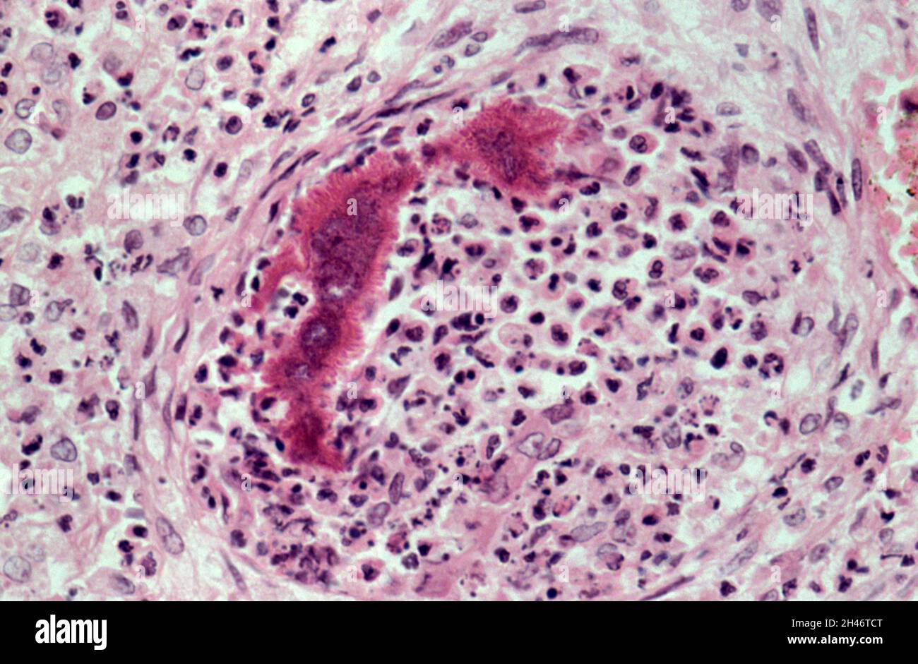 Kidney: pyaemic abscess Stock Photo - Alamy