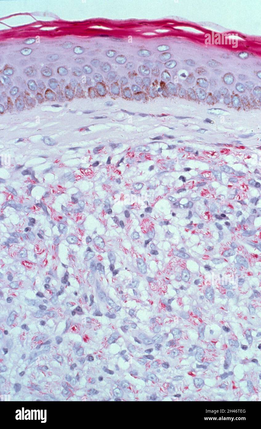 Lepromatous leprosy: histoid leprosy Stock Photo - Alamy