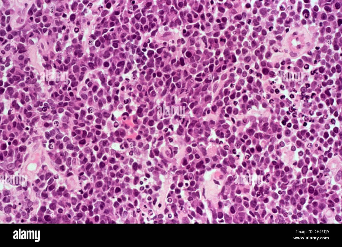 Non-Hodgkin's lymphoma with HIV Stock Photo - Alamy