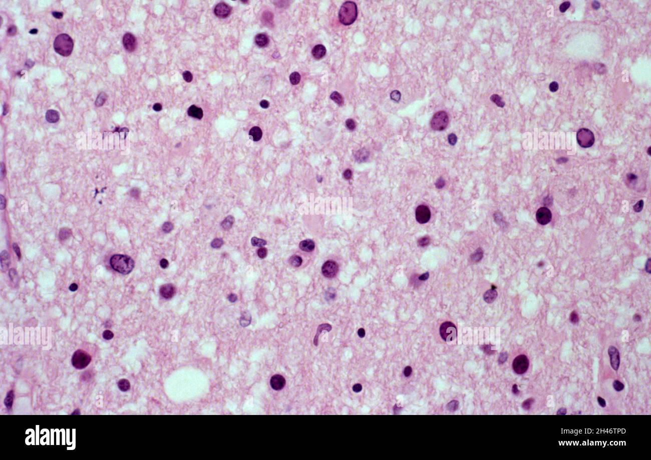Progressive Multifocal Leukoencephalopathy Histology