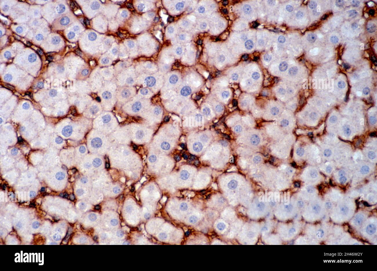 Hyperreactive malarial splenomegaly (HMS Stock Photo - Alamy