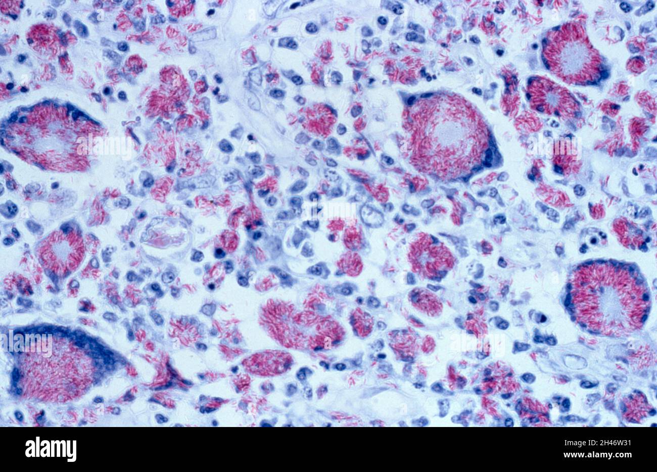 Mycobacterium avium-intracellulare infection Stock Photo - Alamy