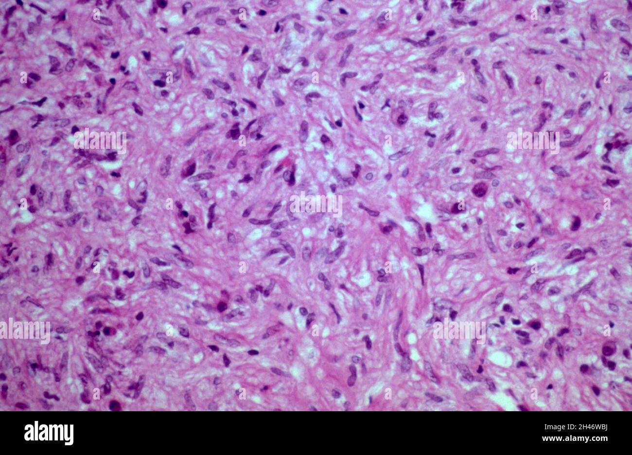Lepromatous leprosy: histoid leprosy Stock Photo - Alamy