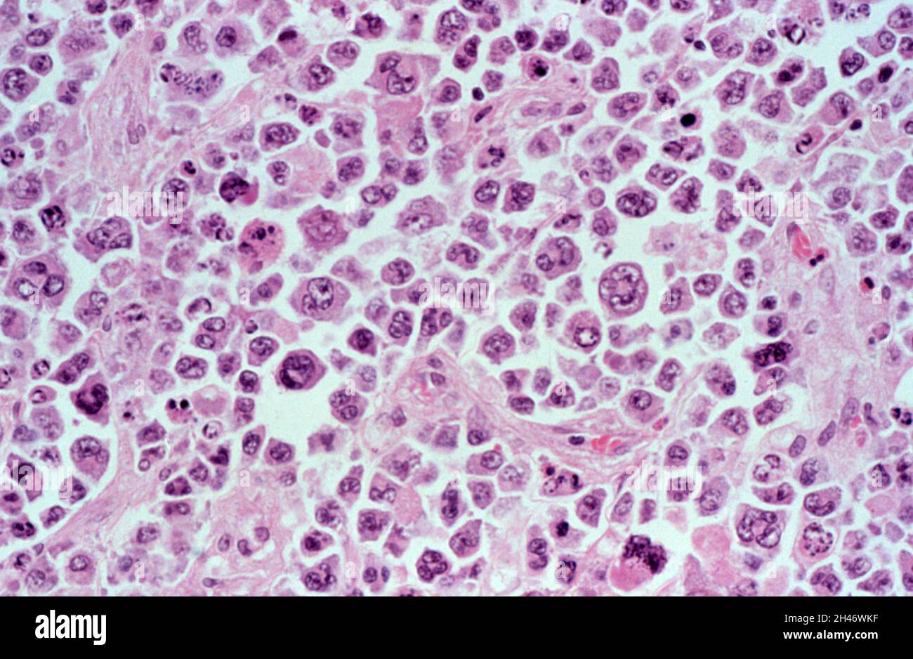 Lymphoma with HIV: colon Stock Photo - Alamy