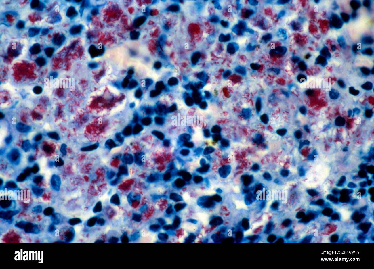 Lepromatous leprosy (LL): lymph node Stock Photo - Alamy