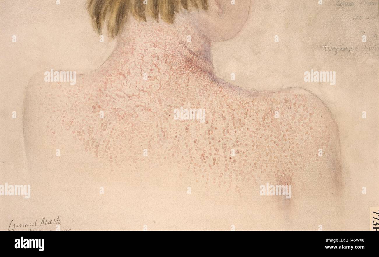 Pityriasis rubra pilaris hi-res stock photography and images - Alamy