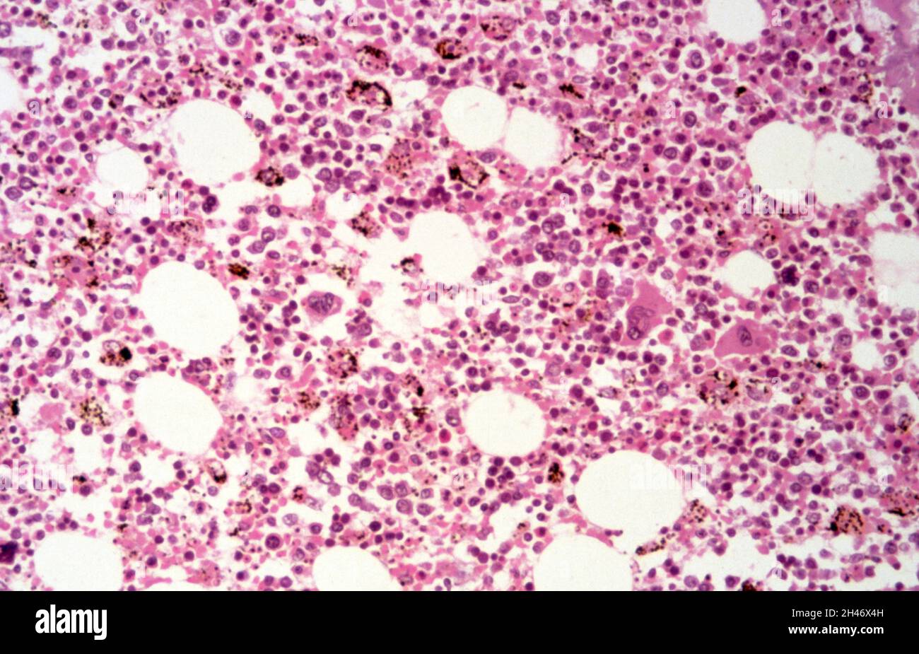 Plasmodium falciparum malaria: bone marrow Stock Photo - Alamy