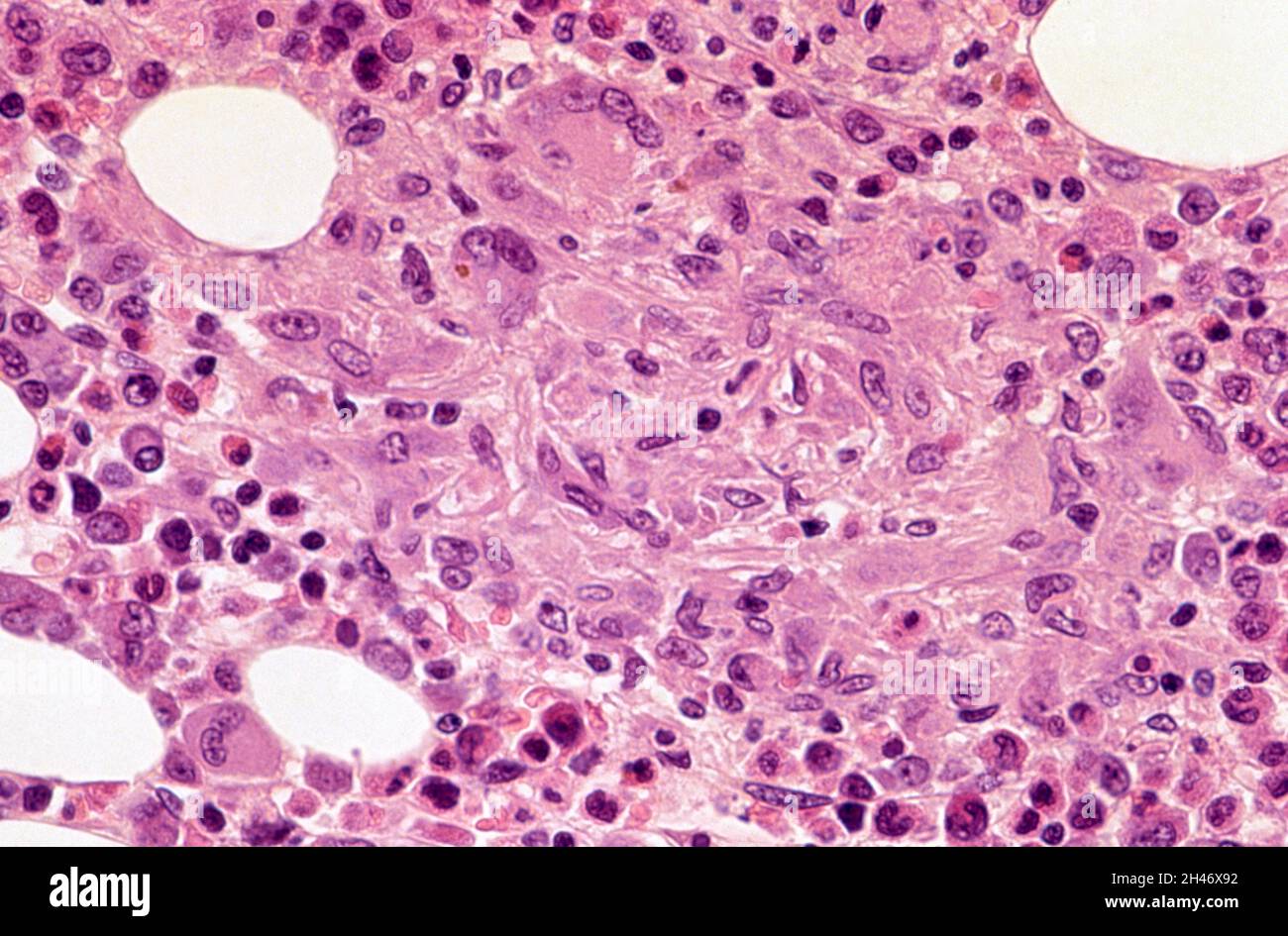 Bone marrow: Mycobacterium genavense infection with AIDS Stock Photo ...