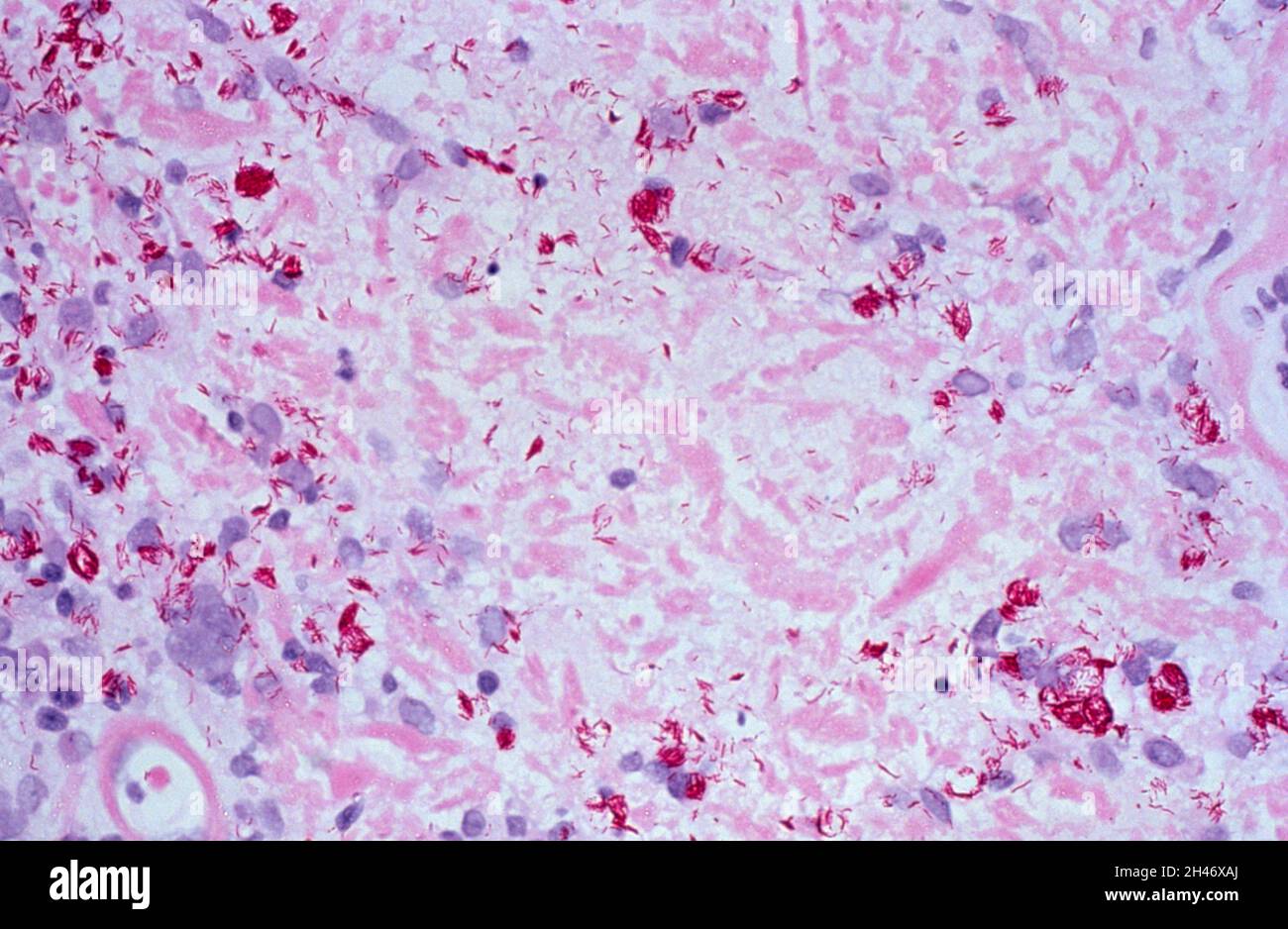 Lepromatous leprosy: local (acute) exacerbation reaction Stock Photo ...