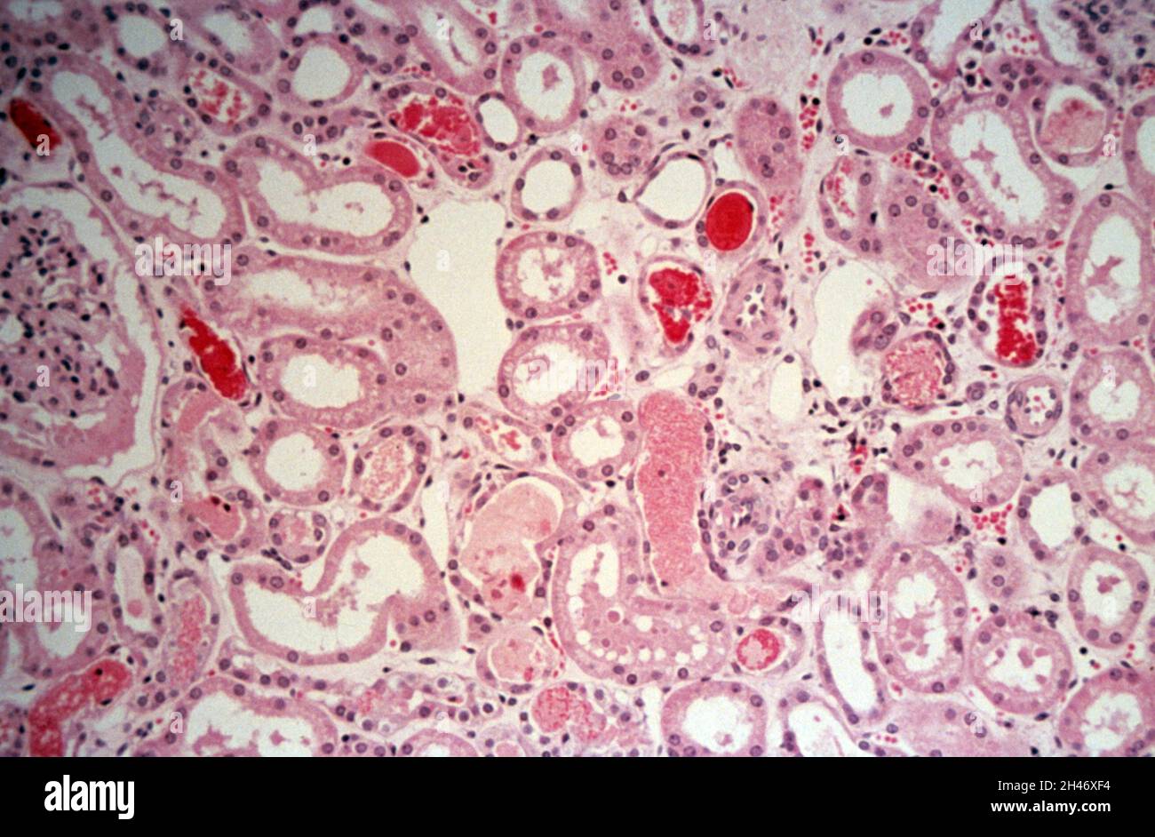 Plasmodium falciparum malaria: blackwater fever Stock Photo - Alamy