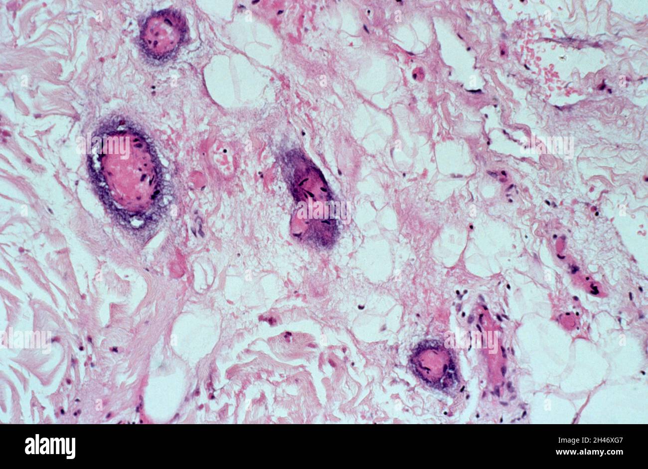 Skin: Pseudomonas aeruginosa vasculitis Stock Photo - Alamy