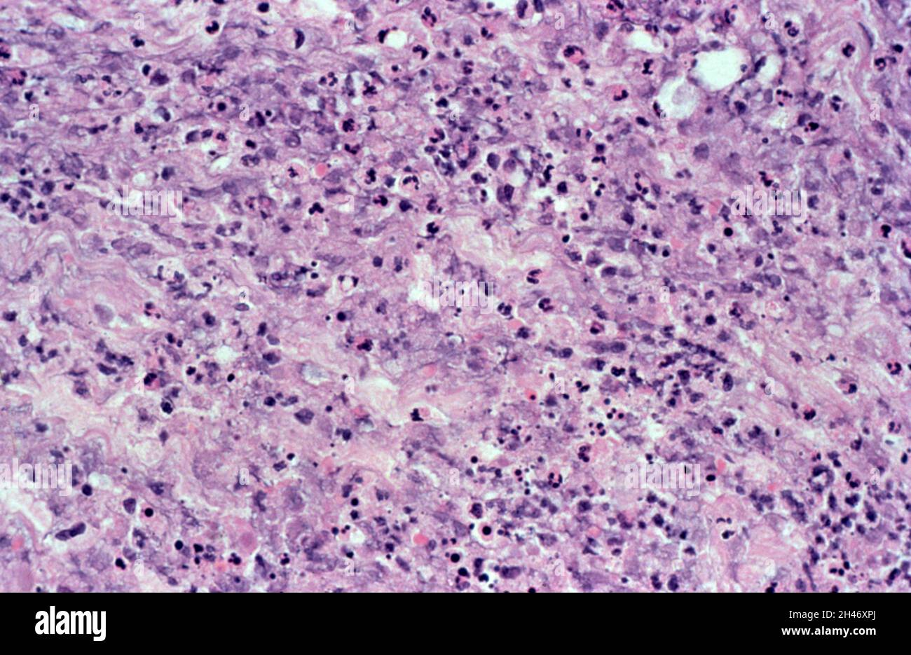 Lepromatous leprosy: type 2 ENL reaction Stock Photo - Alamy