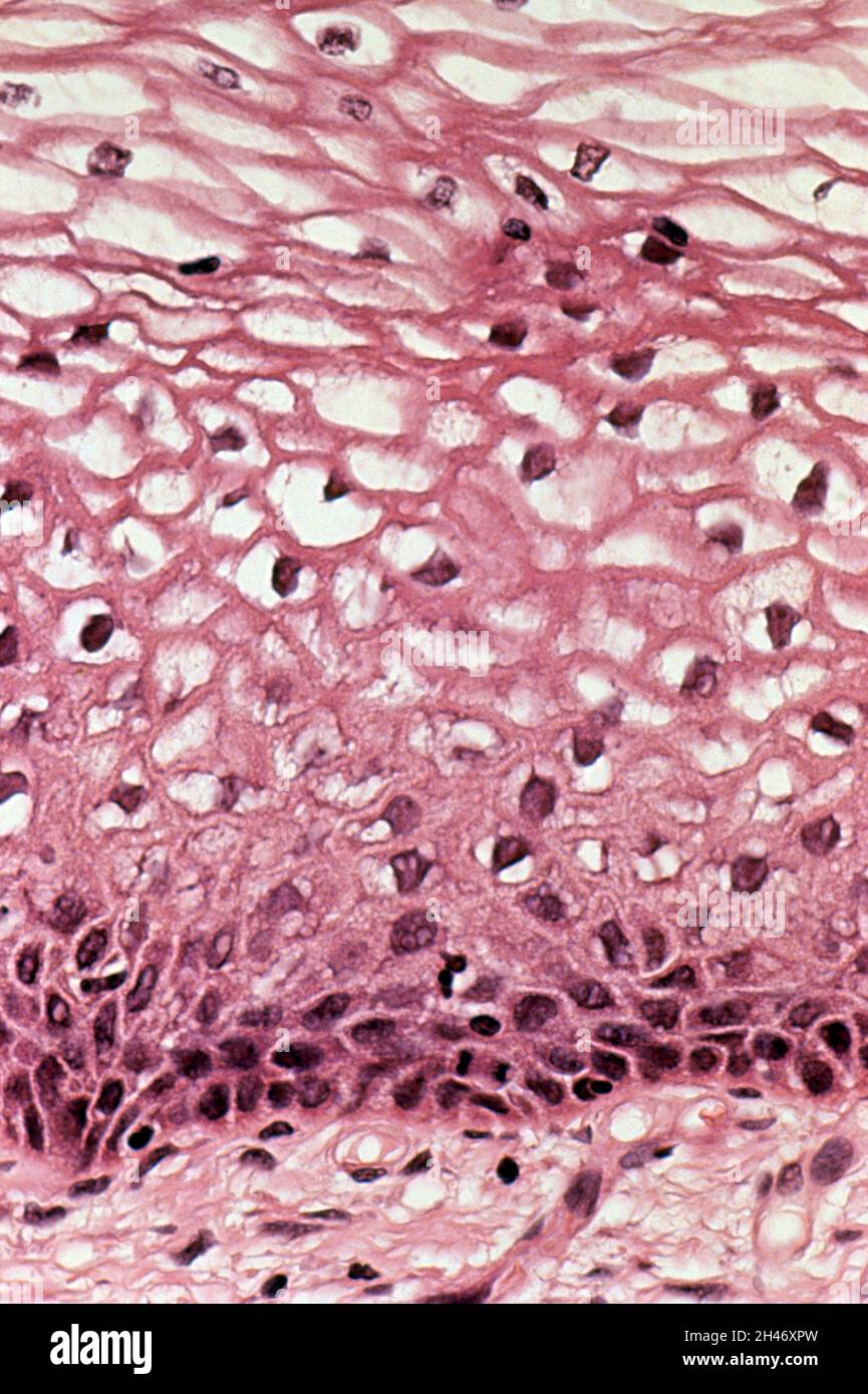 Cervix: human papillomavirus (HPV) infection Stock Photo - Alamy