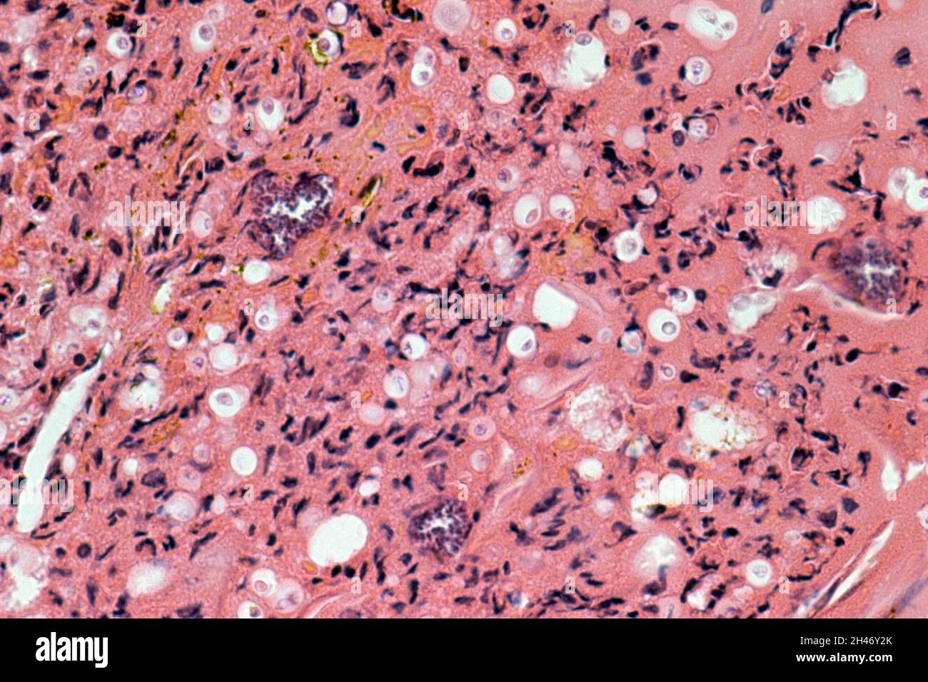 Cryptococcosis hi-res stock photography and images - Alamy