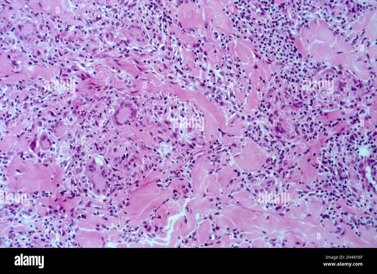 Leprosy: histopathology of skin Stock Photo - Alamy