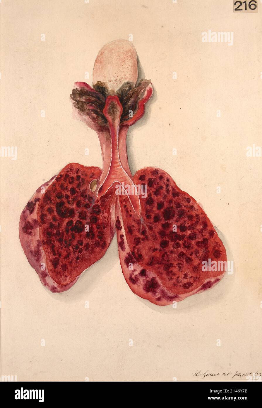 Tonsils diphtheria hi-res stock photography and images - Alamy