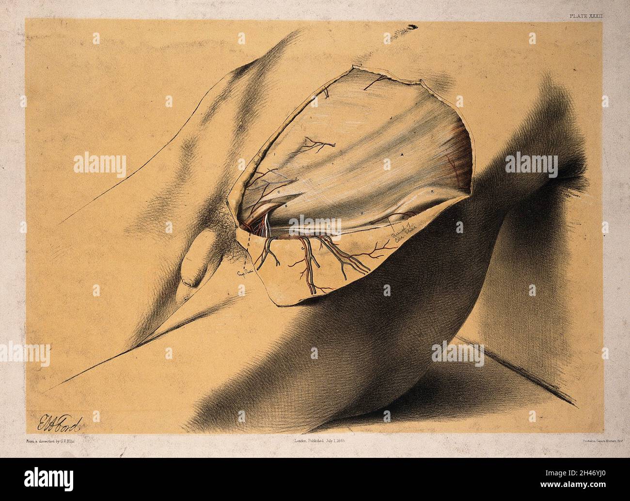 Dissection of the groin and lower abdomen of a man, with the muscles ...
