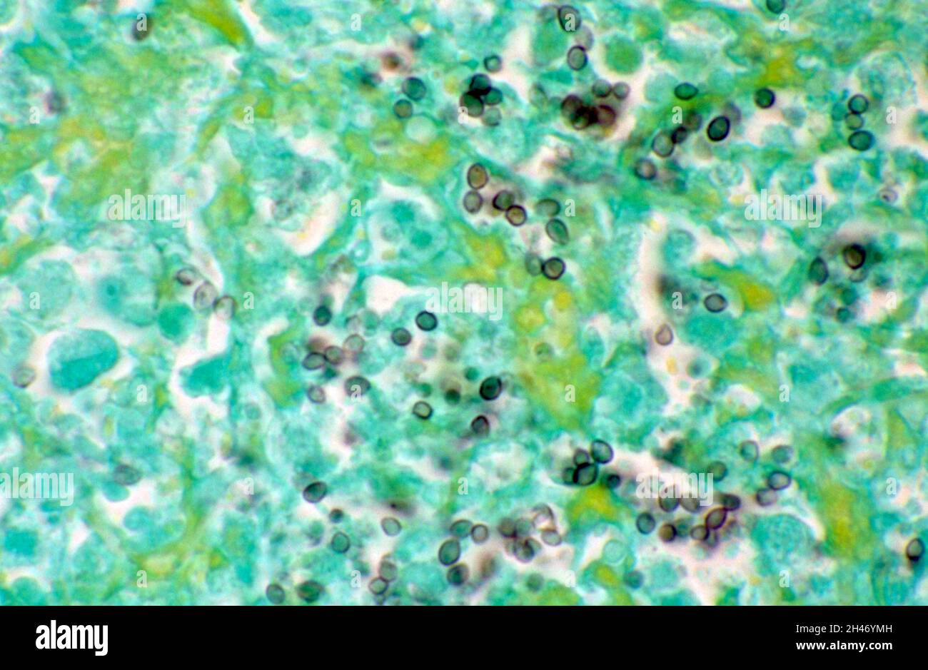 Histoplasmosis lung High Resolution Stock Photography and Images - Alamy