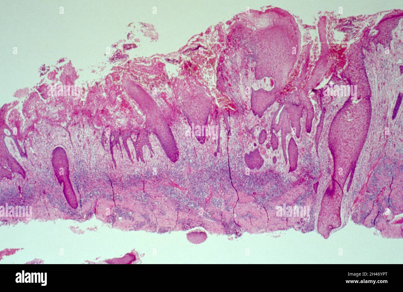 Amoebiasis: Histopathology of the skin Stock Photo - Alamy