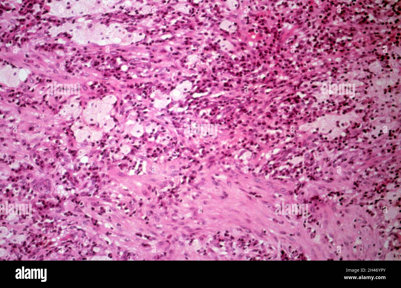 Skin granuloma hi-res stock photography and images - Alamy