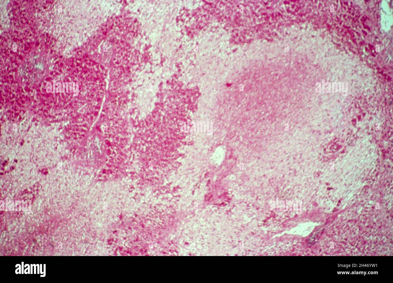 Sickle cell disease: liver Stock Photo - Alamy