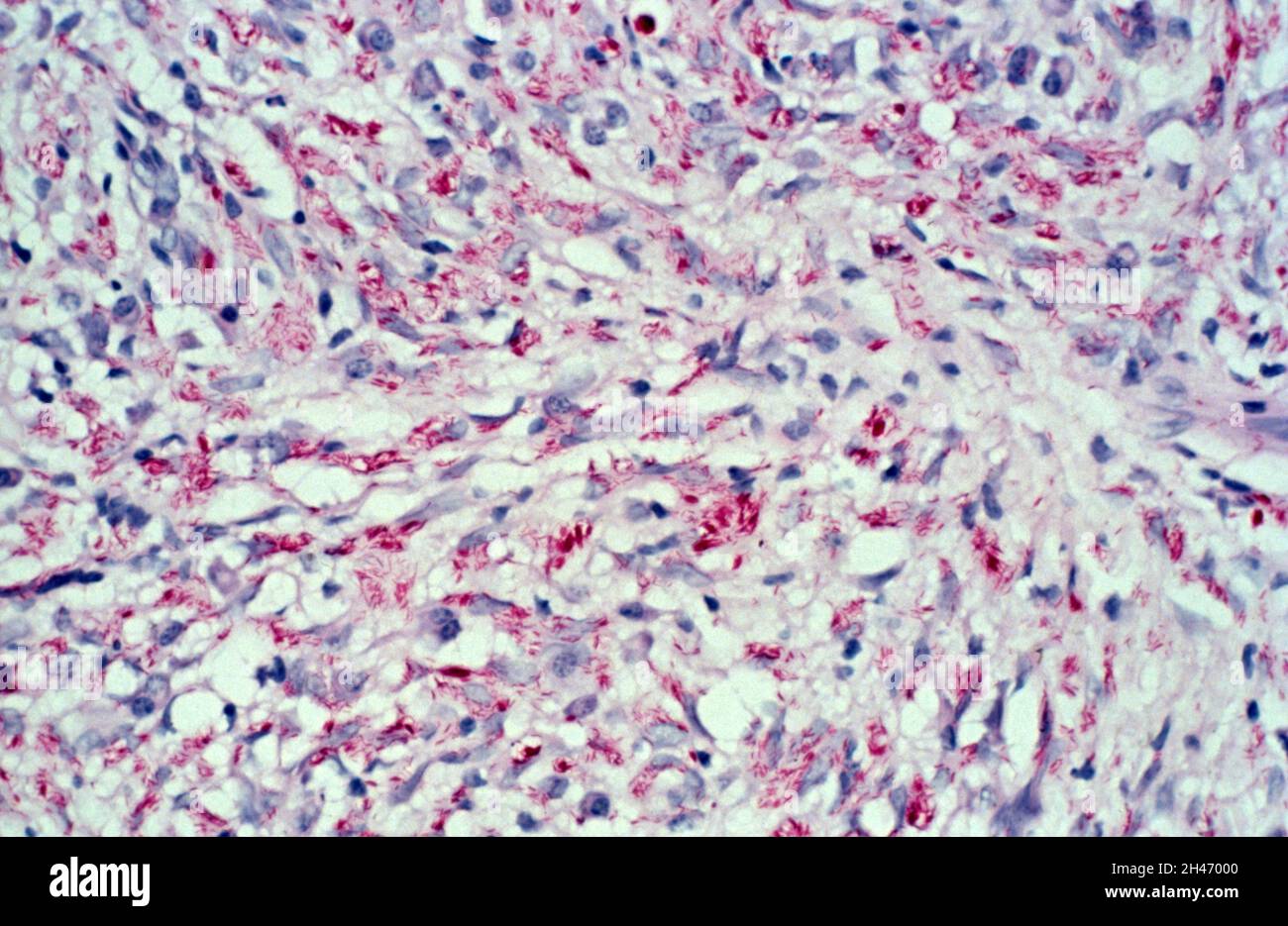 Lepromatous leprosy: histoid leprosy Stock Photo - Alamy
