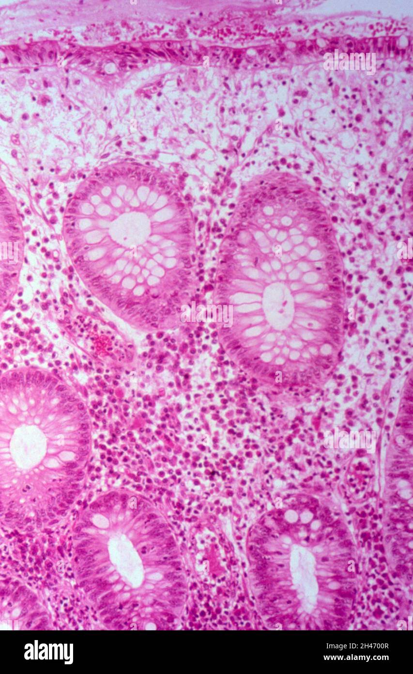 Amoebiasis: histopathology of the colon Stock Photo - Alamy