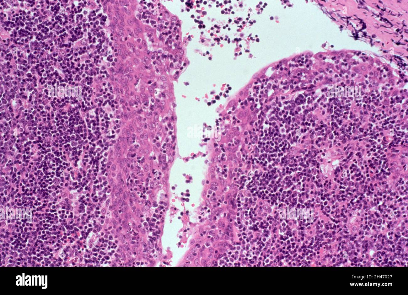 Parotid gland: lymphoepithelial cyst with HIV Stock Photo - Alamy