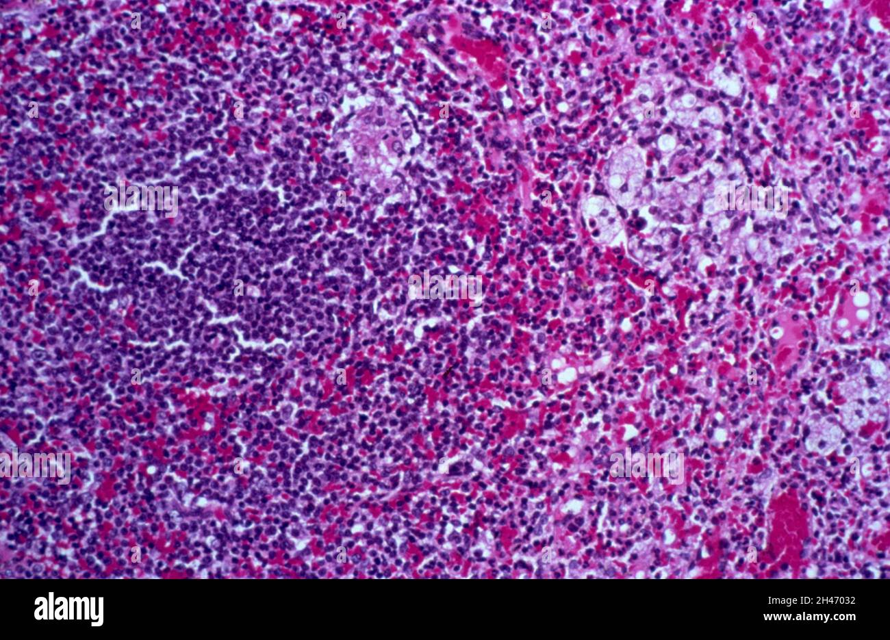 Lepromatous Leprosy High Resolution Stock Photography and Images - Alamy