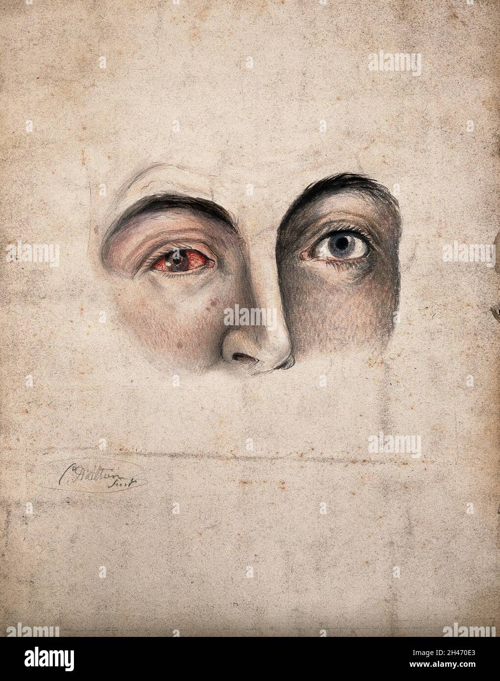 A section of a face (eyes and nose) with a disease affecting one eye ...