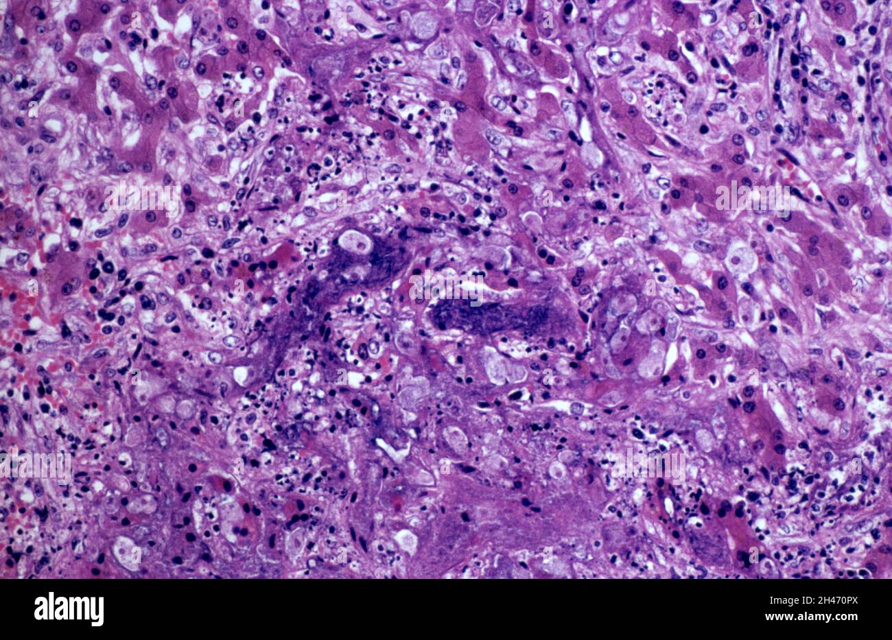 Amoebiasis: amoebic abscess in liver Stock Photo - Alamy