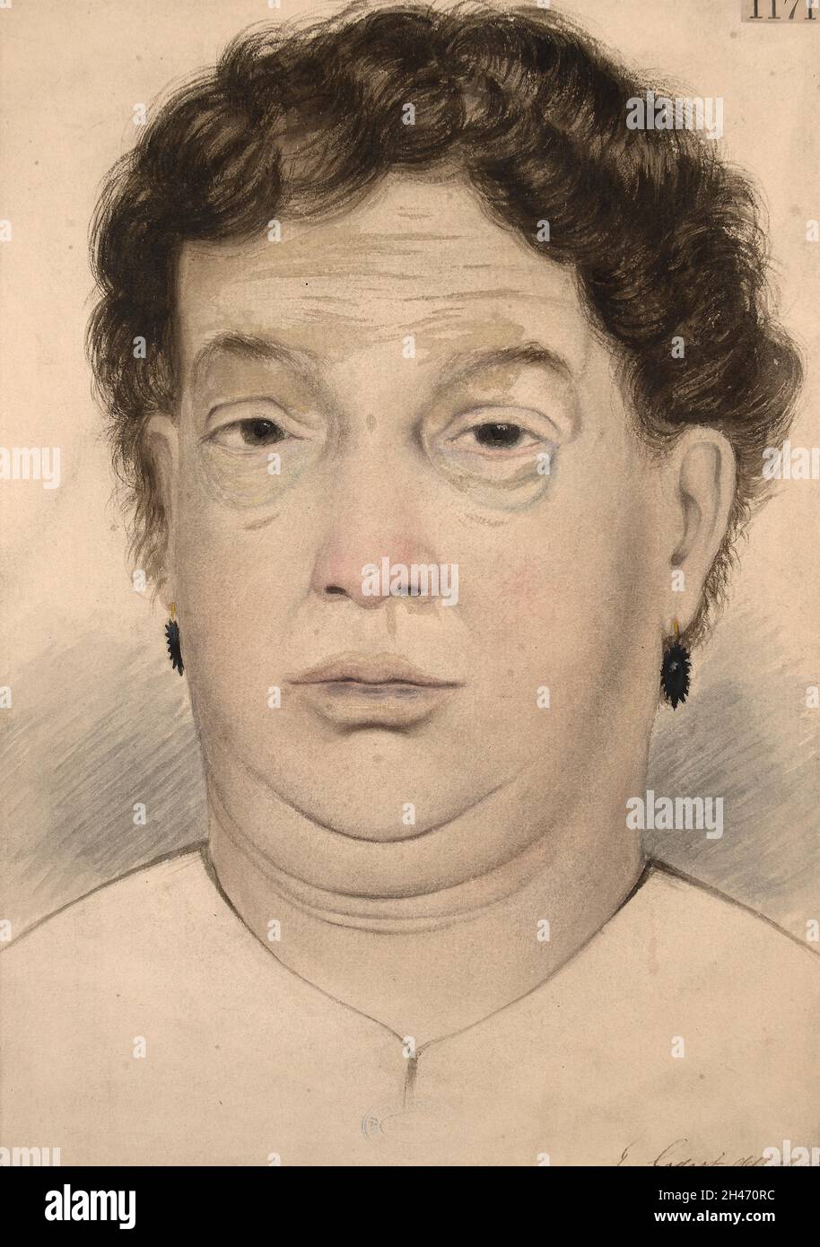 Face of a woman who had been affected with myxoedema for seven years ...