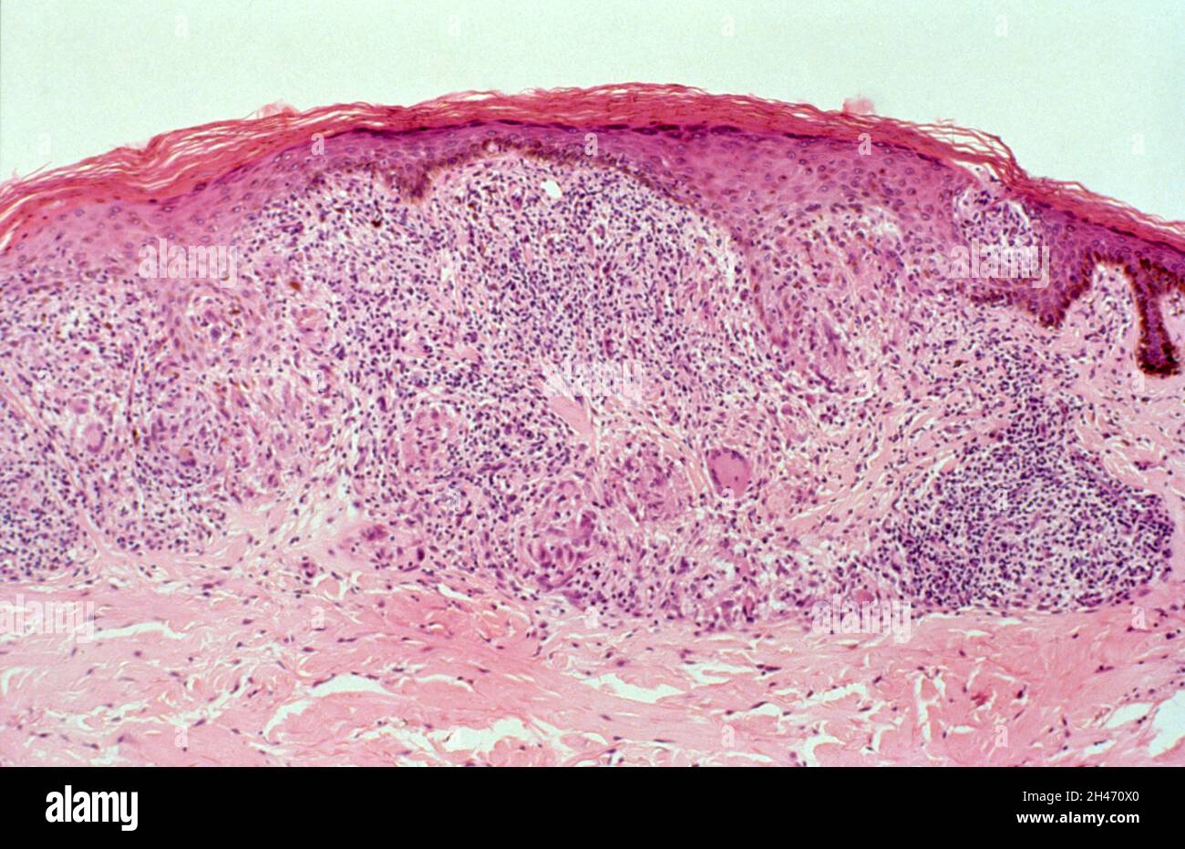 Leprosy bacterial infection hi-res stock photography and images - Alamy