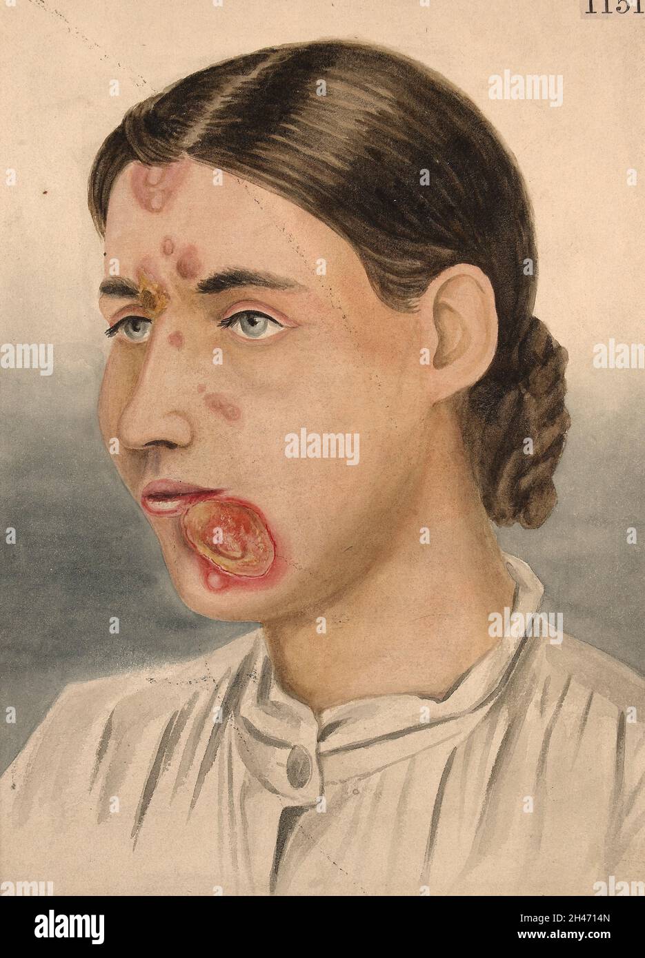 Tertiary Syphilis Face